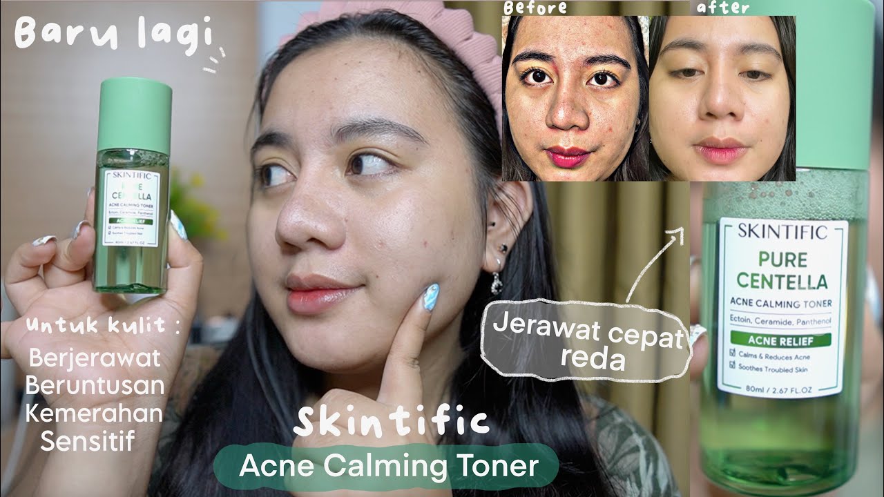 BARU LAGI | REVIEW SKINTIFIC PURE CENTELLA ACNE CALMING TONER | KULIT ...