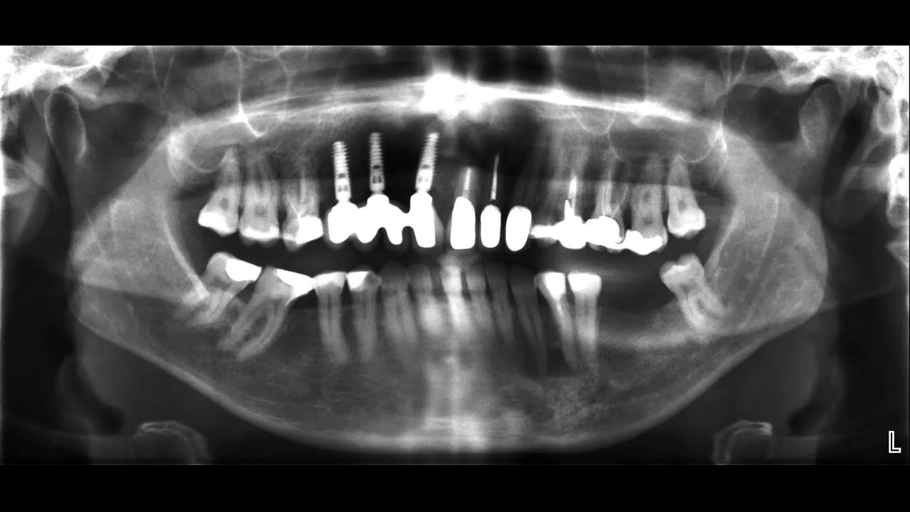 für Zahnärzte: das OPTG Röntgen - YouTube