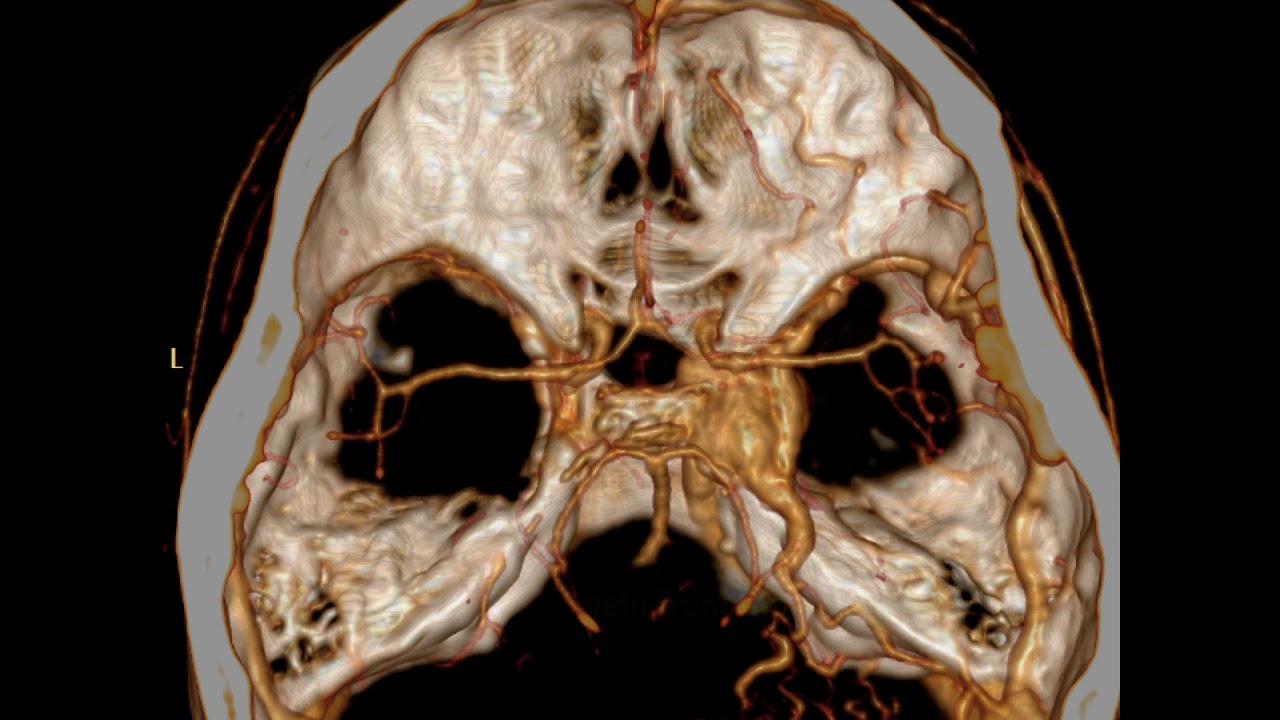 CTA-guided outflow-targeted embolization of direct carotid-cavernous ...