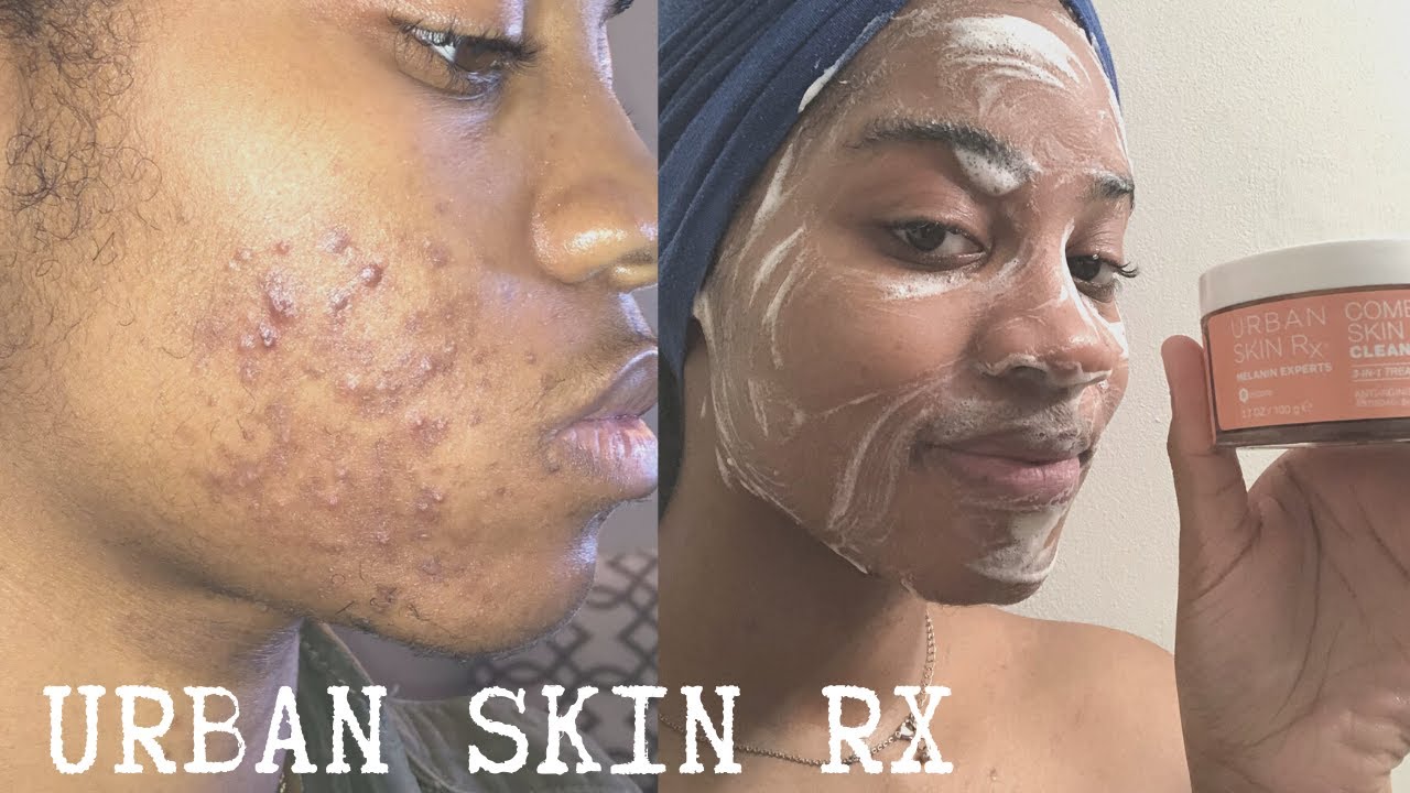 URBAN SKIN RX | COMBINATION SKIN CLEANSING BAR | GOT RID OF MY ACNE ...
