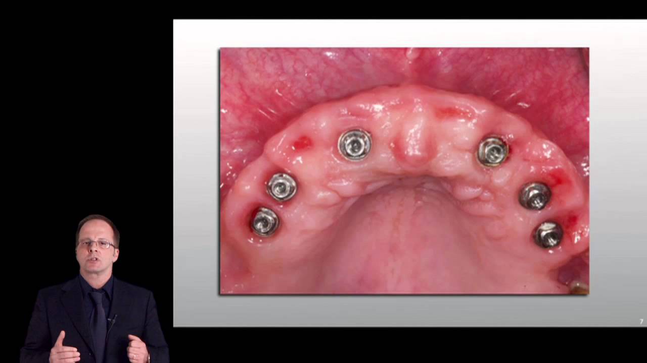 165-00 Fixed Hybrid Prosthesis: New Materials & Protocols PREVIEW - YouTube