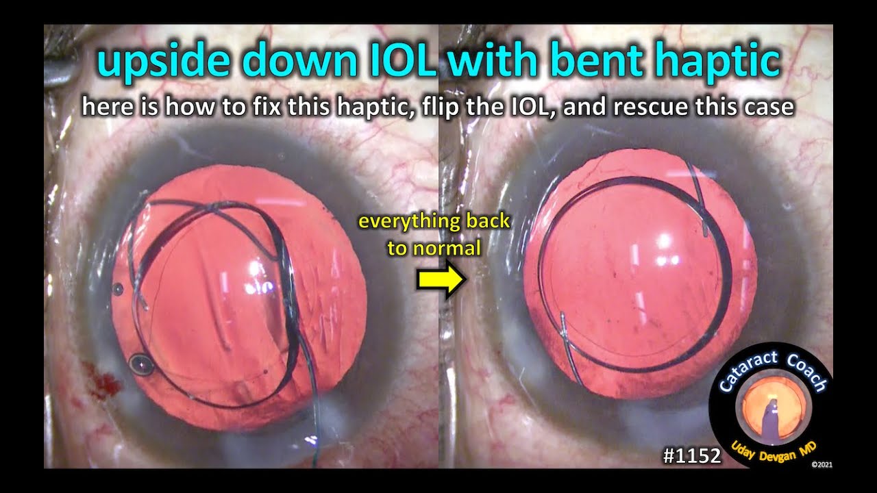 CataractCoach 1152: rescue this upside down IOL with a bent haptic ...