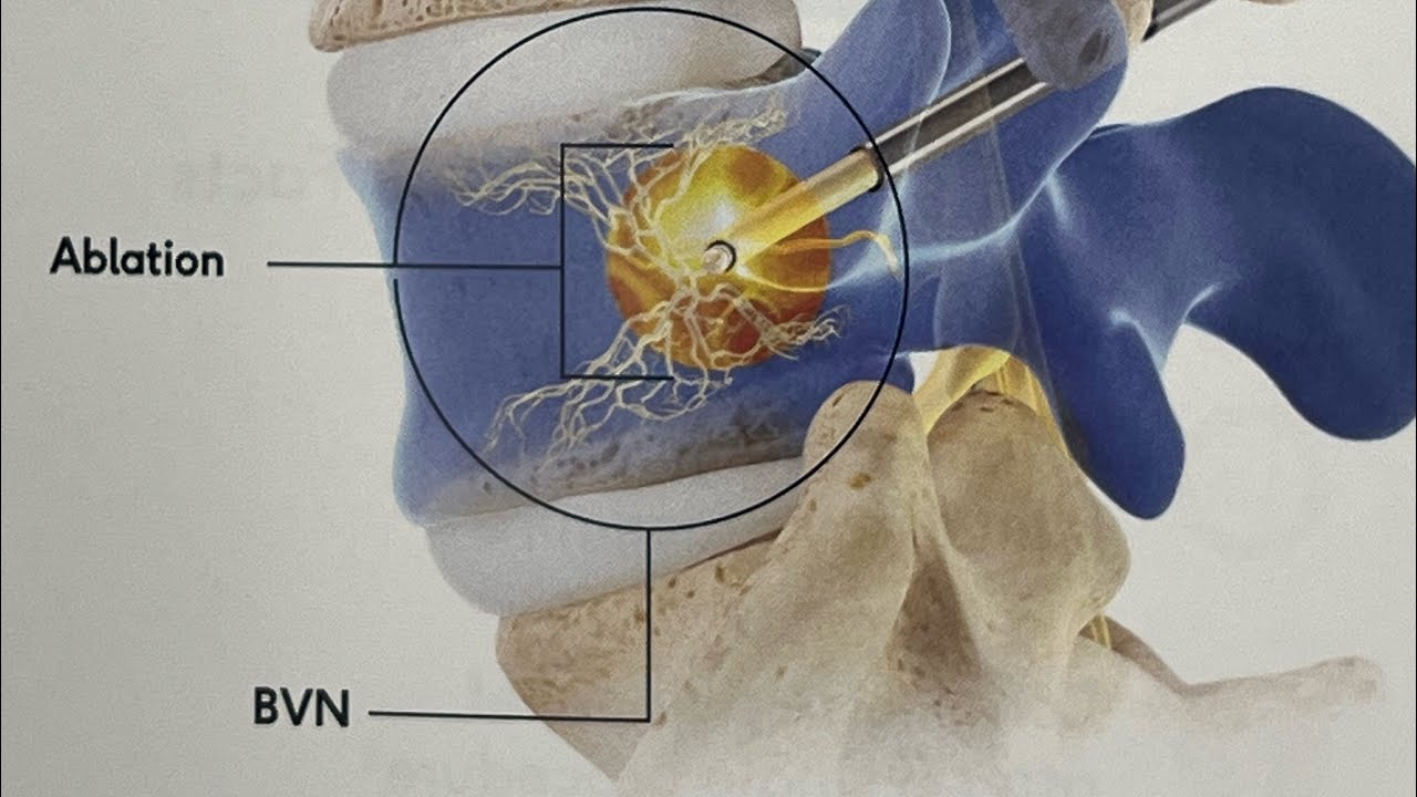 Results from my Intracept Back surgery… - YouTube