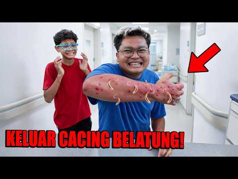 NGERI!!! YUTA TERKENA CACAR AIR DAN KELUAR CACING BELATUNG DI TANGAN NYA!