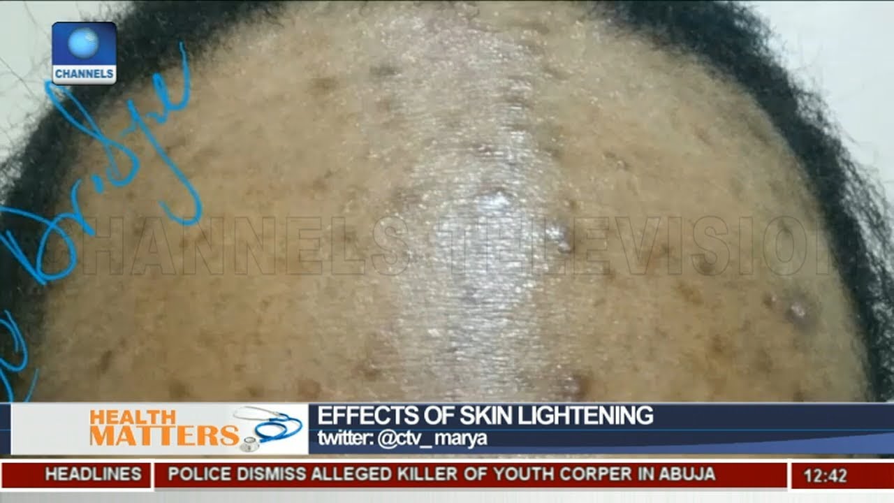 Skin Lightening Dangerous To Our Health, Dermatologist Highlights ...
