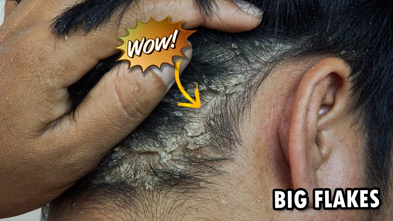 Scratching Big Flakes On Scalp!!! Dandruff Removal Satisfying #338 ...