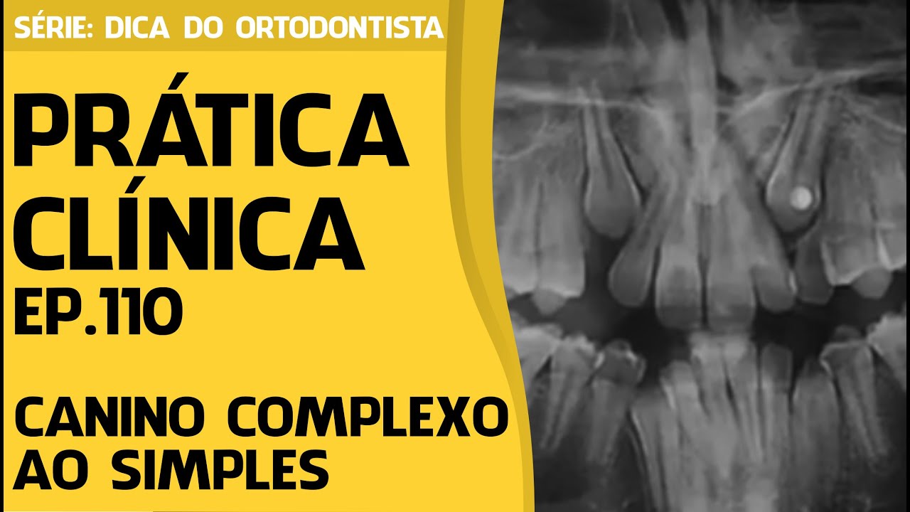 COMO TORNAR O TRATAMENTO DE CANINO IMPACTADO COMPLEXO EM SIMPLES? I DR ...