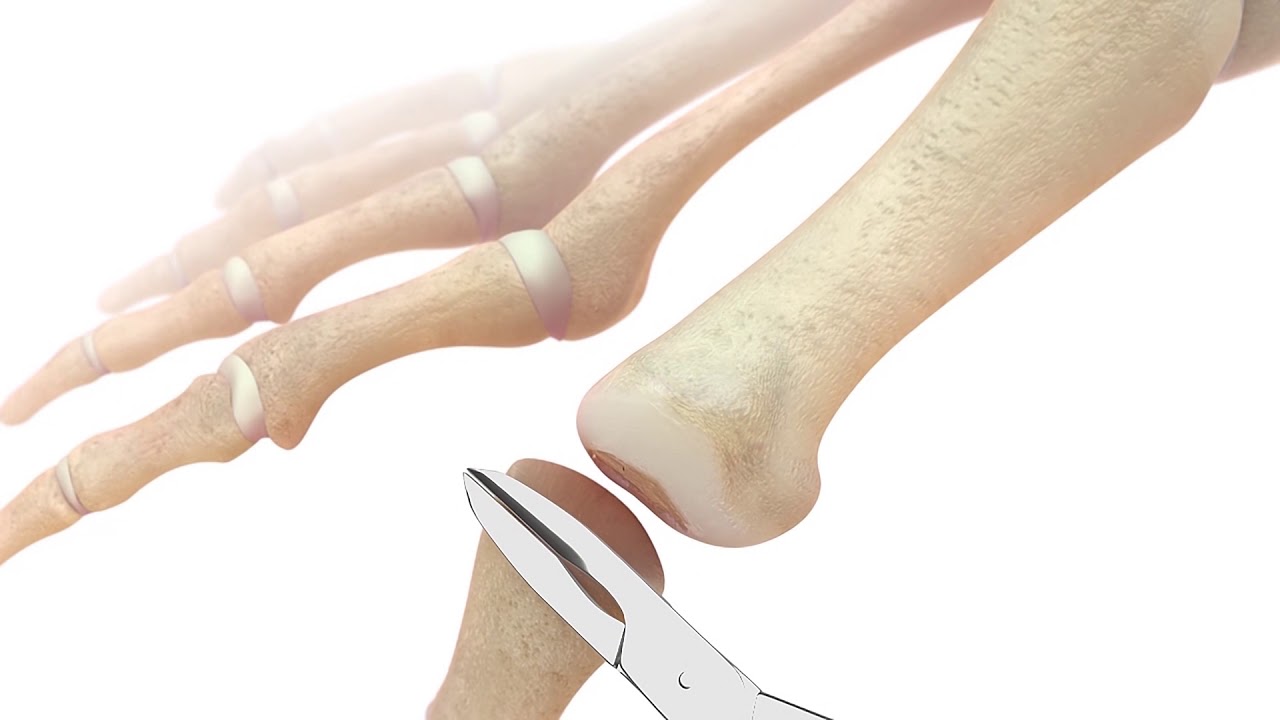 Cartiva 1st MTP Single Use Animated Procedure - YouTube