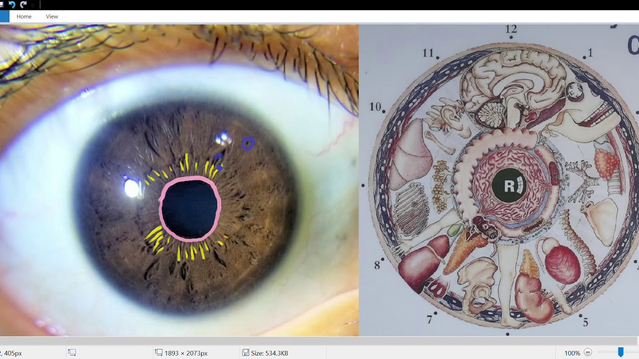 Iridology Lesson Iris Reading 13 Pt 2 Iridology Reading With Dr iridology-lesson-iris-reading-13-pt-2-iridology-reading-with-dr