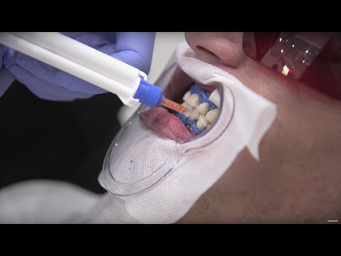 Can Tooth Whitening Hurt Your Teeth? | Earth Science