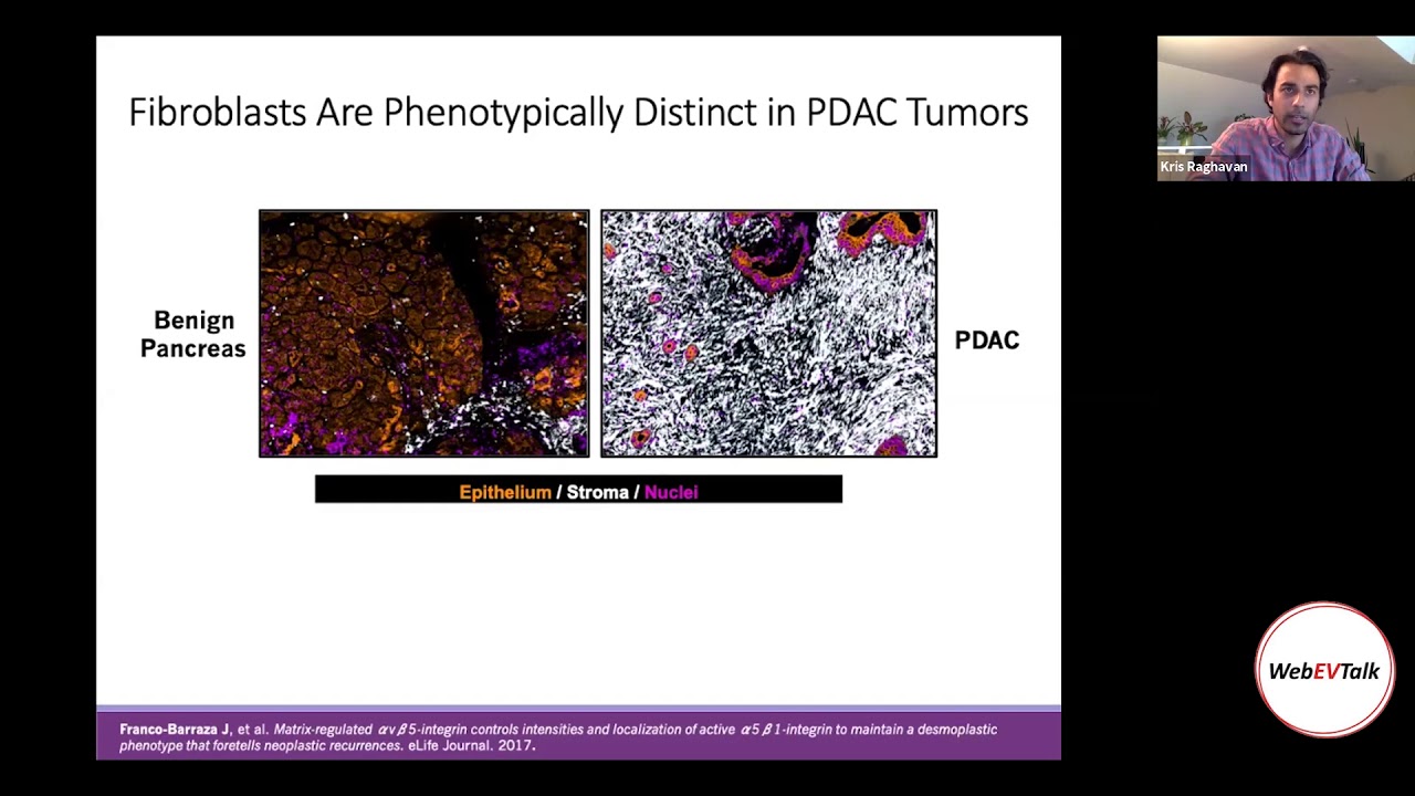 Small Netrin (G1): stroma-Derived Extracellular Vesicles in Pancreatic ...