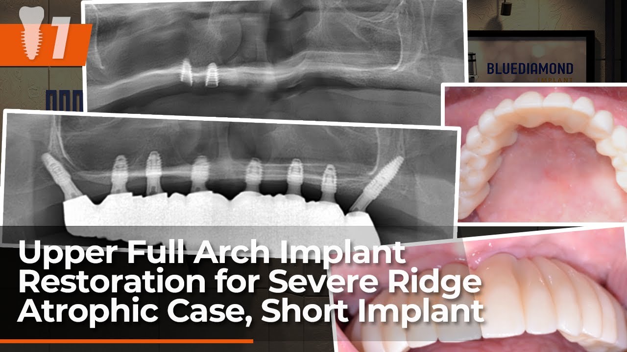 Upper Full Arch Implant Restoration for Severe Ridge Atrophic Case ...
