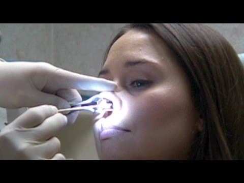 How To Use Silver Nitrate For Nosebleed