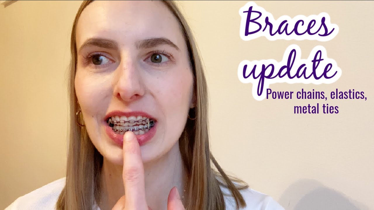 Braces update! - YouTube