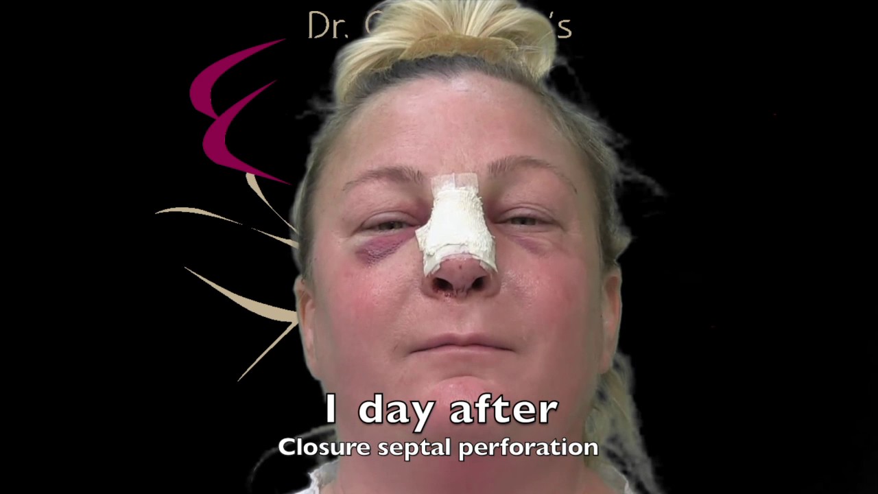 Rhinoplasty plus septal perforation closure S - YouTube
