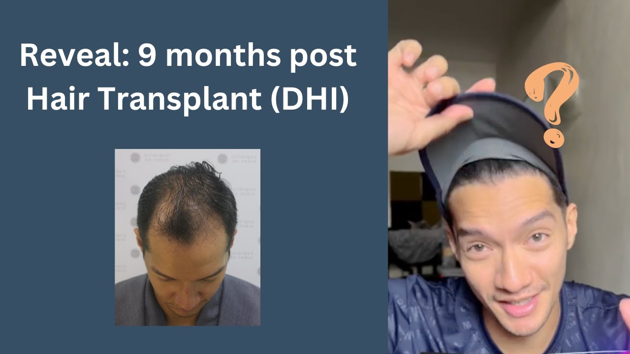 9 months after my DHI Hair Transplant with Clinique de Paris - YouTube