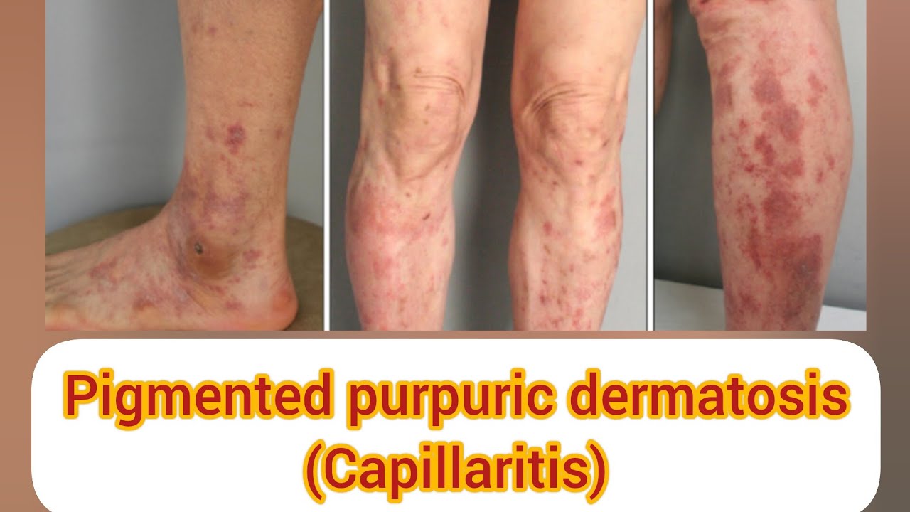 PIGMENTED PURPURIC DERMATOSIS (capillaritis) पैरों में काले भूरे या लाल ...