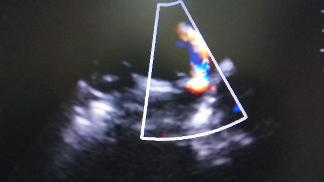 Patent ductus arteriosus (PDA) with bidirectional shunt - YouTube