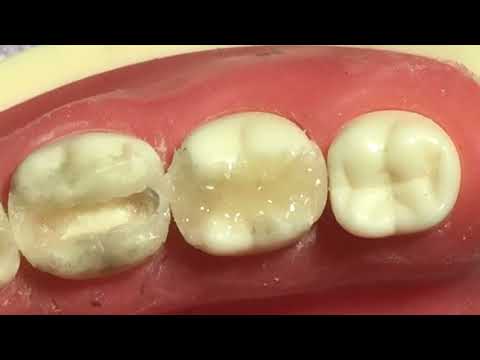 Fast modeling technique composite restoration - YouTube