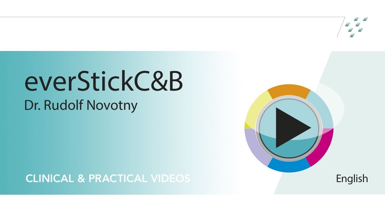 Fibre reinforced composite bridge with everStick C&B– ovoid pontic ...