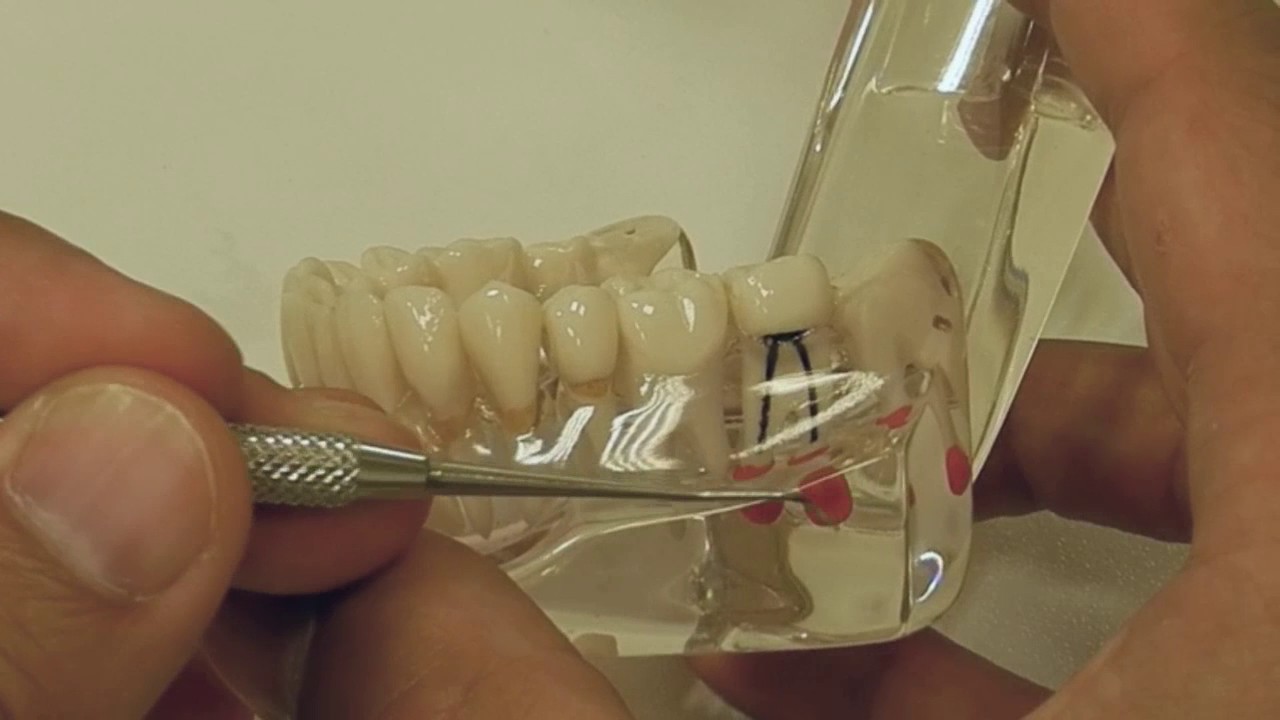 parodontite apicale - YouTube