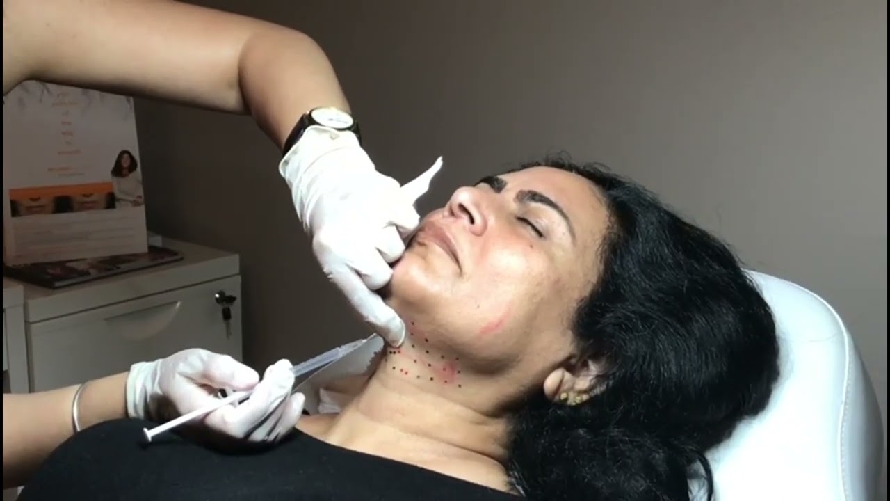 Kybella For Submental Fat - YouTube