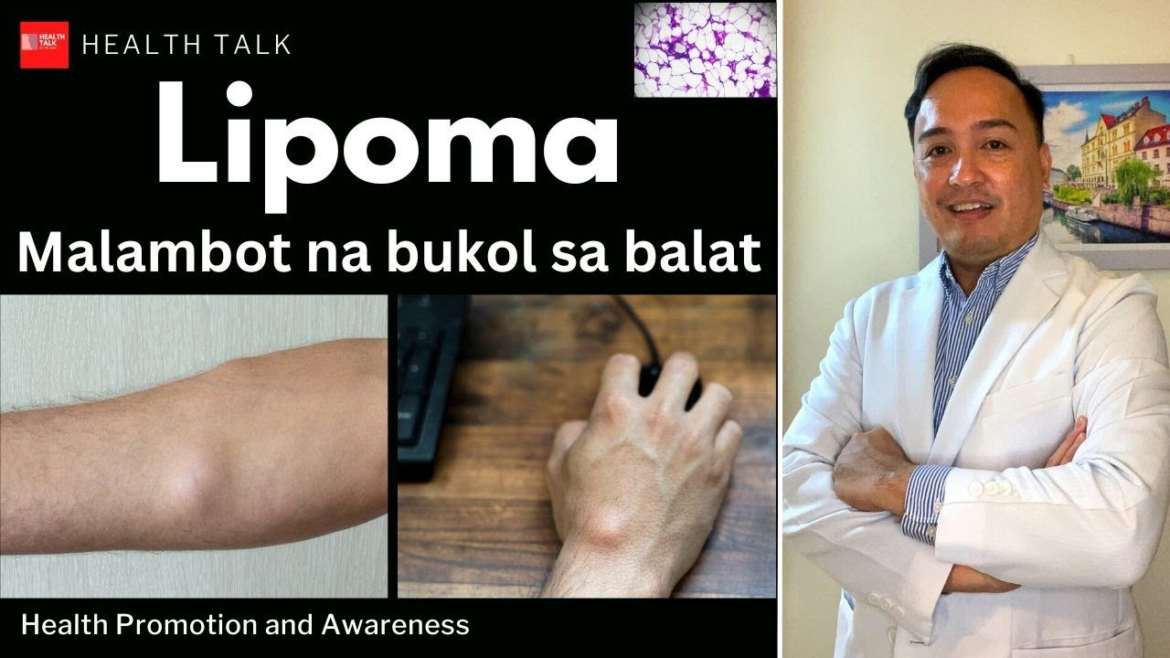 Lipoma: Malambot na bukol sa ilalim ng balat ano ang dapat gawin? - YouTube