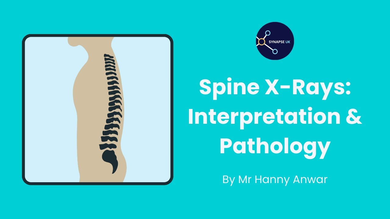 SynapseUK - Spinal X-Rays - Interpretation & Pathology - Mr Hanny Anwar ...