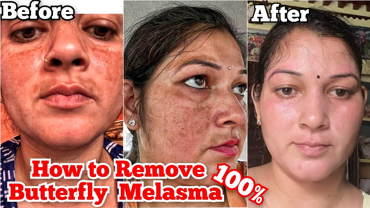 How to Remove Butterfly Pigmentation | Melasma | Pigmentation Removing ...