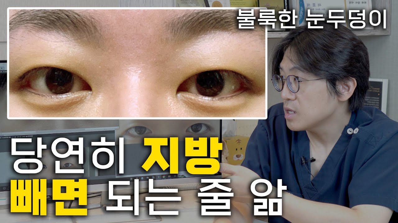 자기 눈두덩이가 눈지방이 많을 때 쌍꺼풀 수술 방법 Youtube