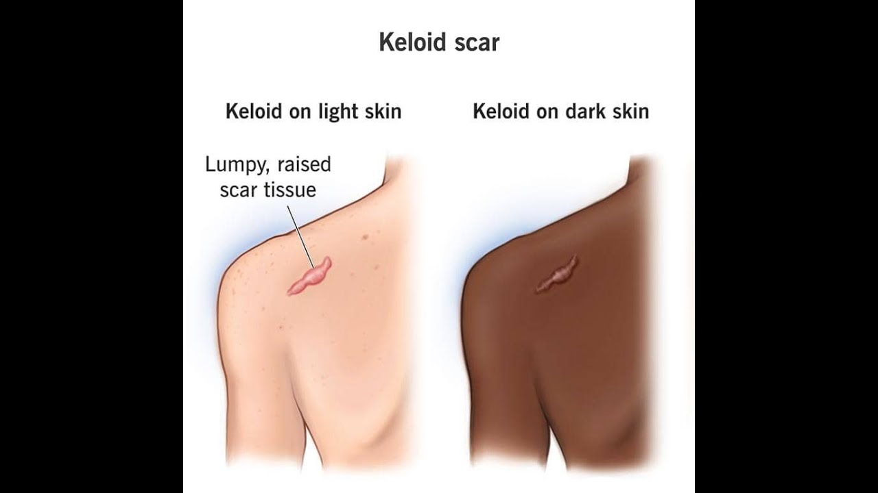 Keloid Scars (Thickened Overgrowth of fibrous Tissue from Wound healing ...