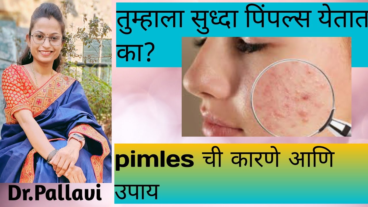 pimples येण्याची कारणे आणि उपाय - YouTube
