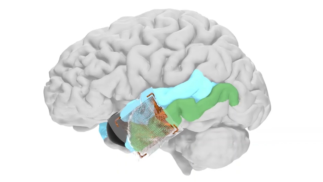 Animation of Human Brain Mapping With Multithousand-Channel Sensor ...