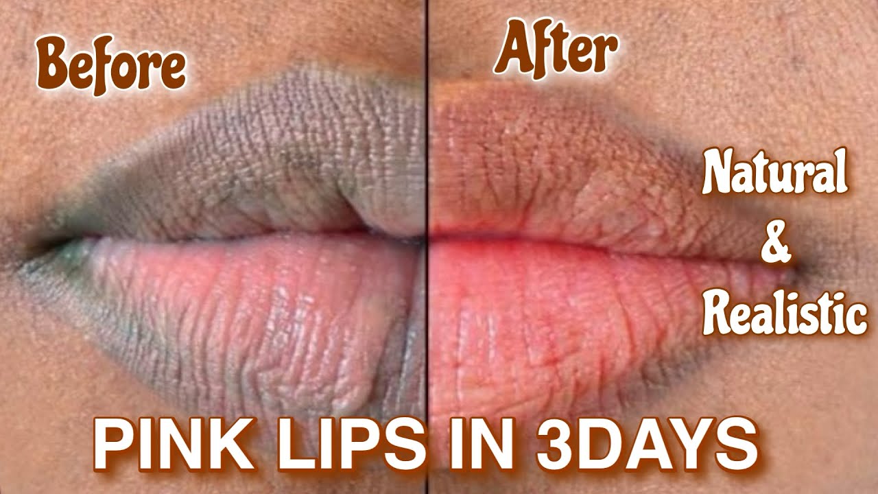 GET PINK LIPS IN DAYS| HOW TO GET RID OF DARK, DRY & CHAPPED LIPS # ...