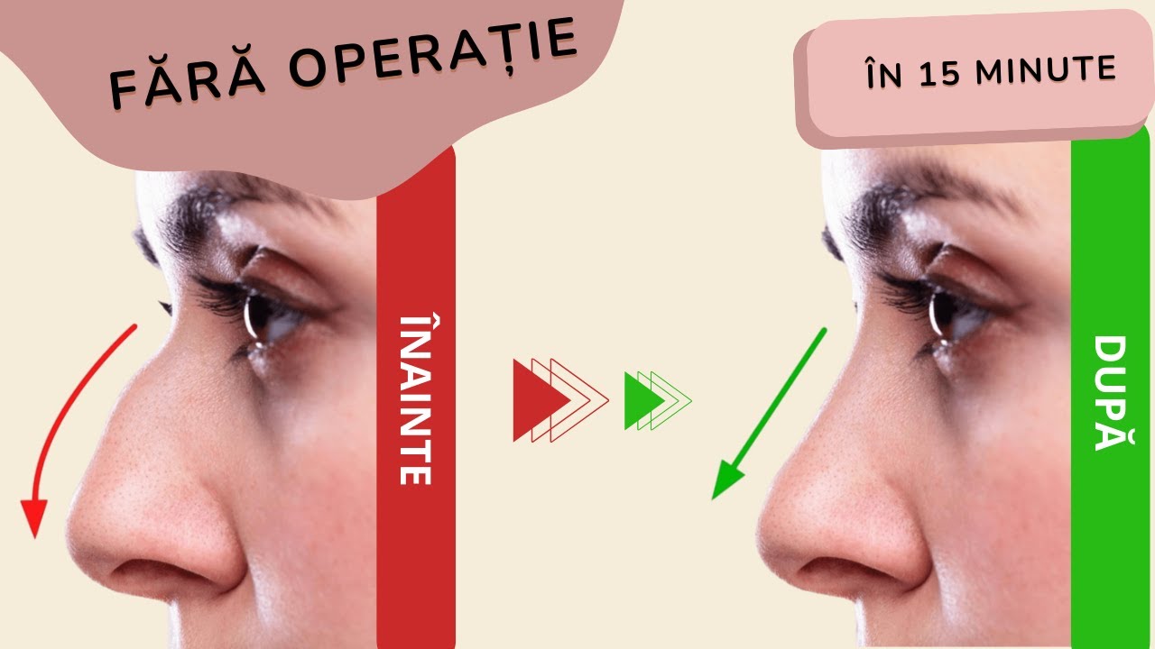 Un nas mai frumos fără bisturiu, cât ai spune rinocorecție cu acid ...