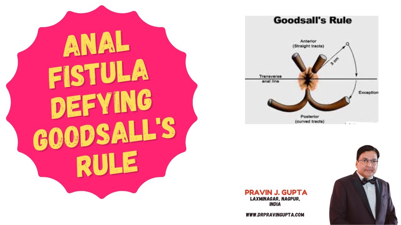GOODSALL'S RULE FOR ANAL FISTULA IS NOT ALWAYS CORRECT - YouTube