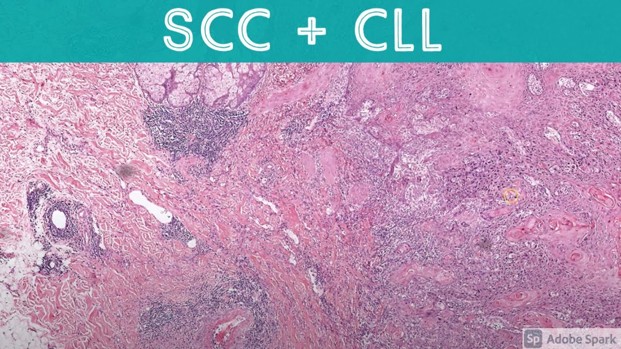 SCC+CLL: squamous cell carcinoma plus chronic lymphocytic leukemia ...
