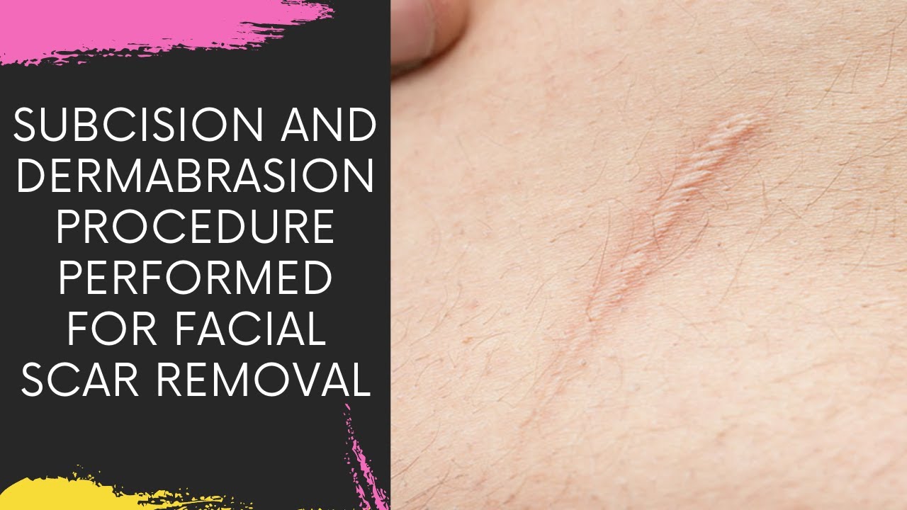 SUBCISION AND DERMABRASION PROCEDURE PERFORMED FOR FACIAL SCAR REMOVAL ...