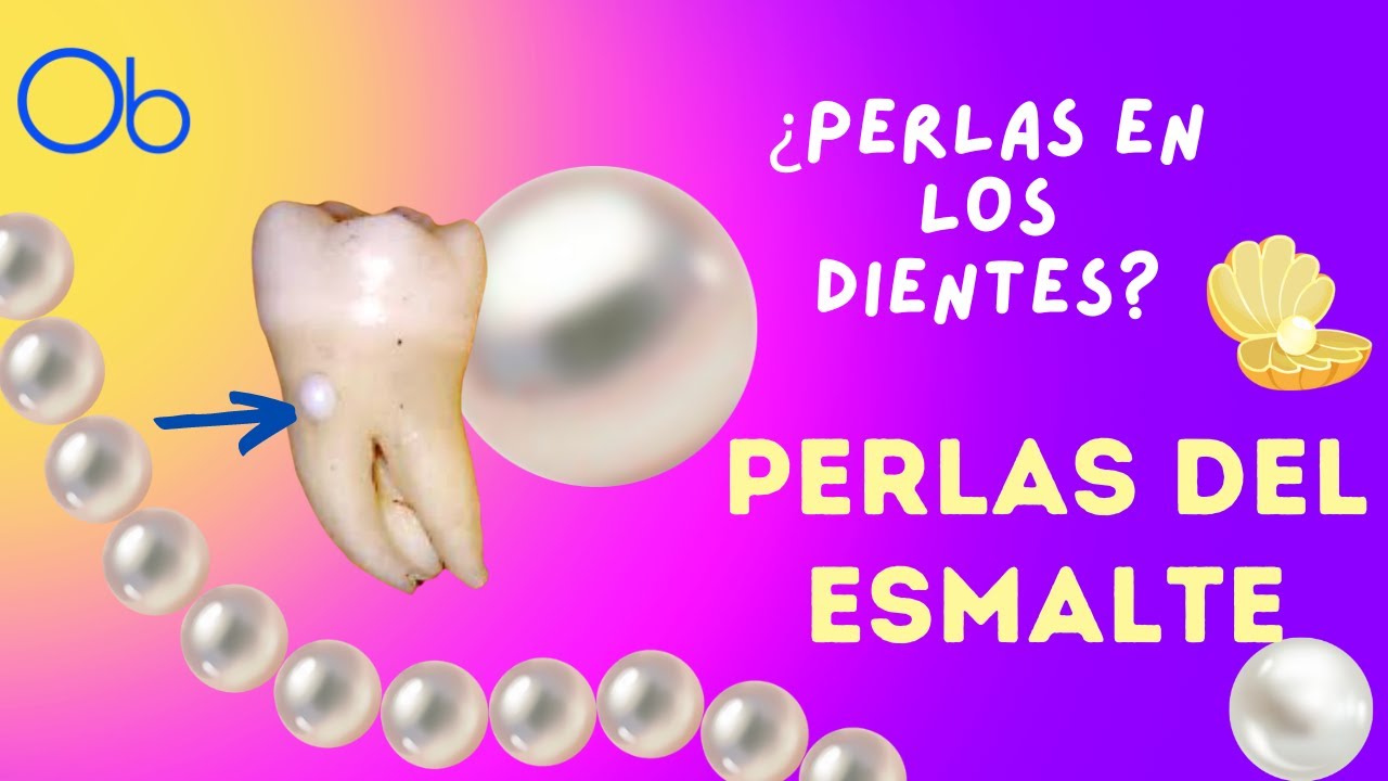 ¿Perlas en los dientes? ⚪️🦷 PERLAS DEL ESMALTE - YouTube