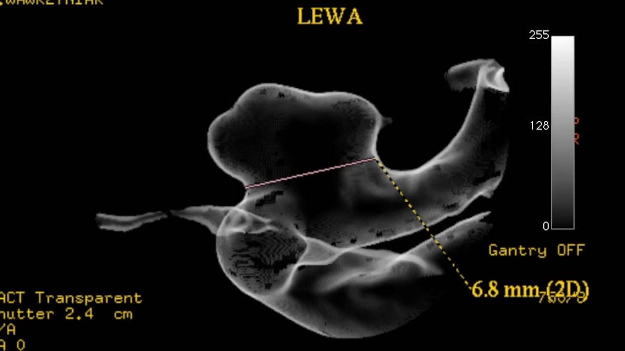 Left ophthalmic ICA aneurysm approached from the right - YouTube