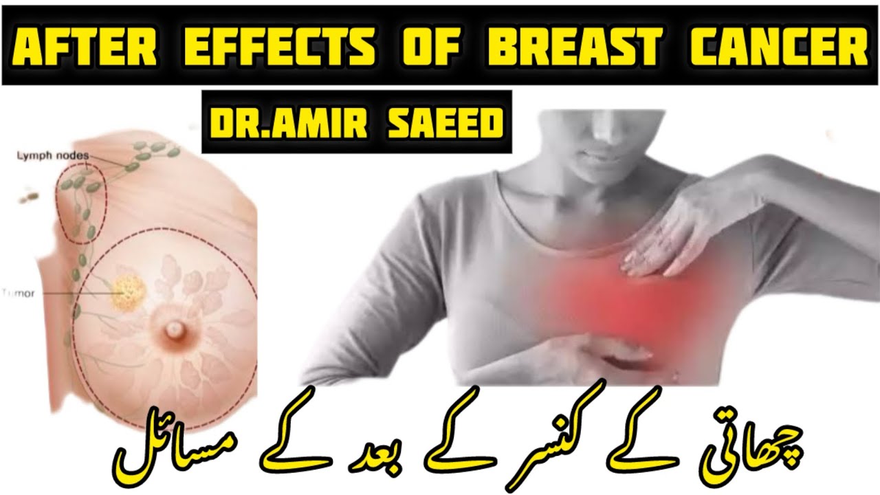 Breast Cancer after effects | Effective Physiotherapy Treatment | Dr ...
