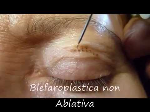 Blefaroplastica non Ablativa al Plasma: l'idea del prof. Fippi - il ...