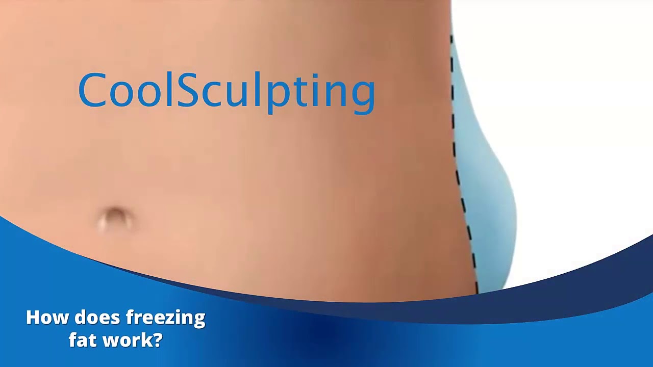 Cool Sculpting Fat Reduction Treatment - YouTube