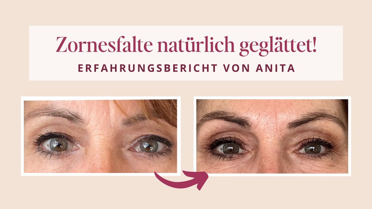 Zornesfalte natürlich geglättet! - Erfahrungsbericht von Anita - YouTube