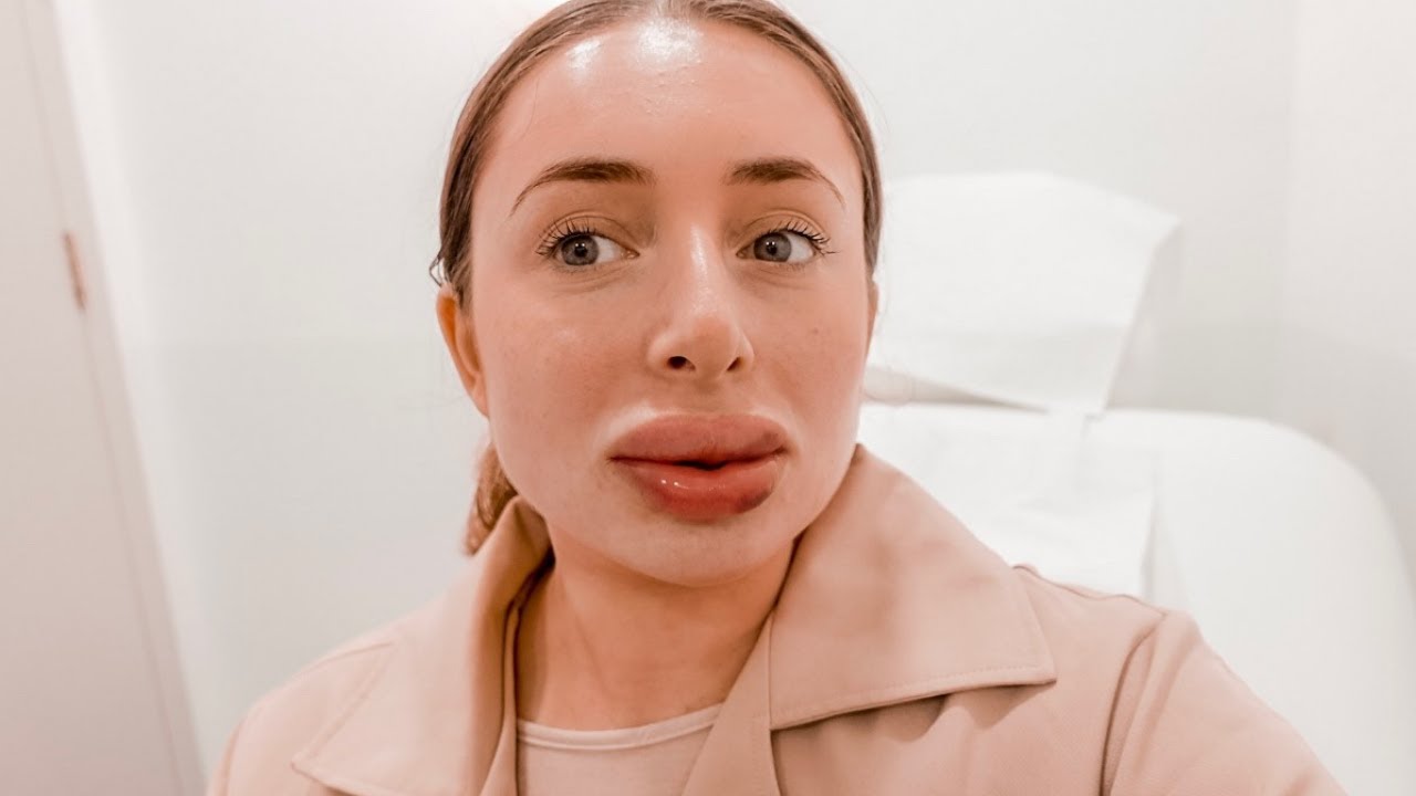 I GOT MY BOTCHED LIP FILLER DISSOLVED AFTER 3 YEARS! *OMG* - YouTube