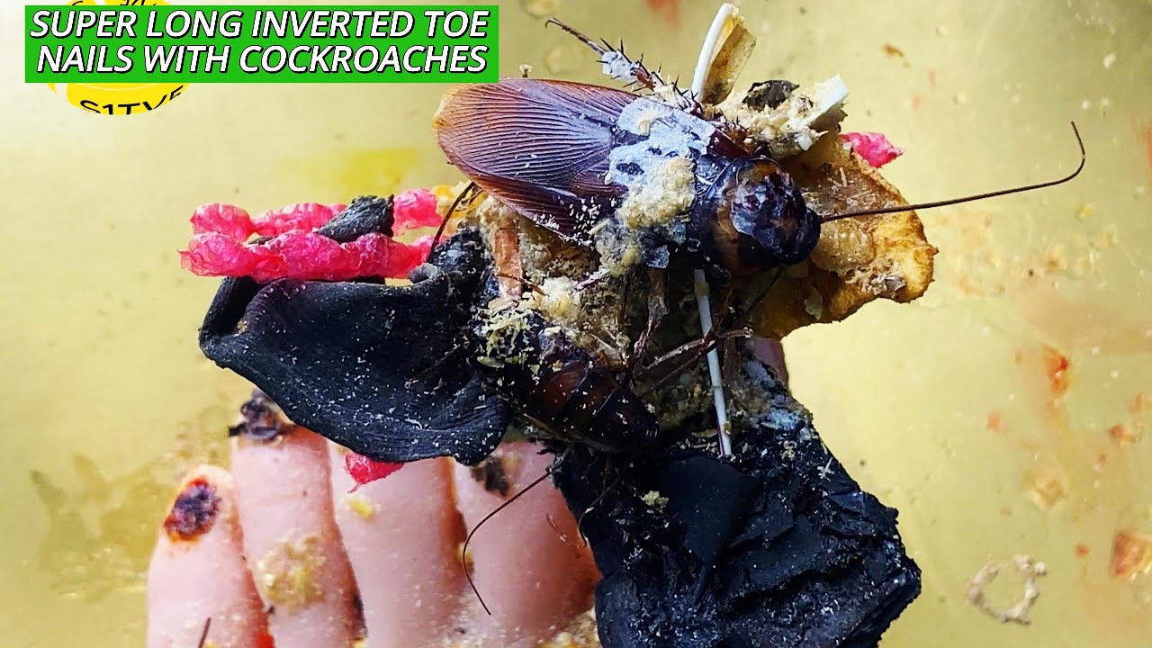 Trim ingrown toenails like horns😭 inverted toenails😭 toenail fungus ...