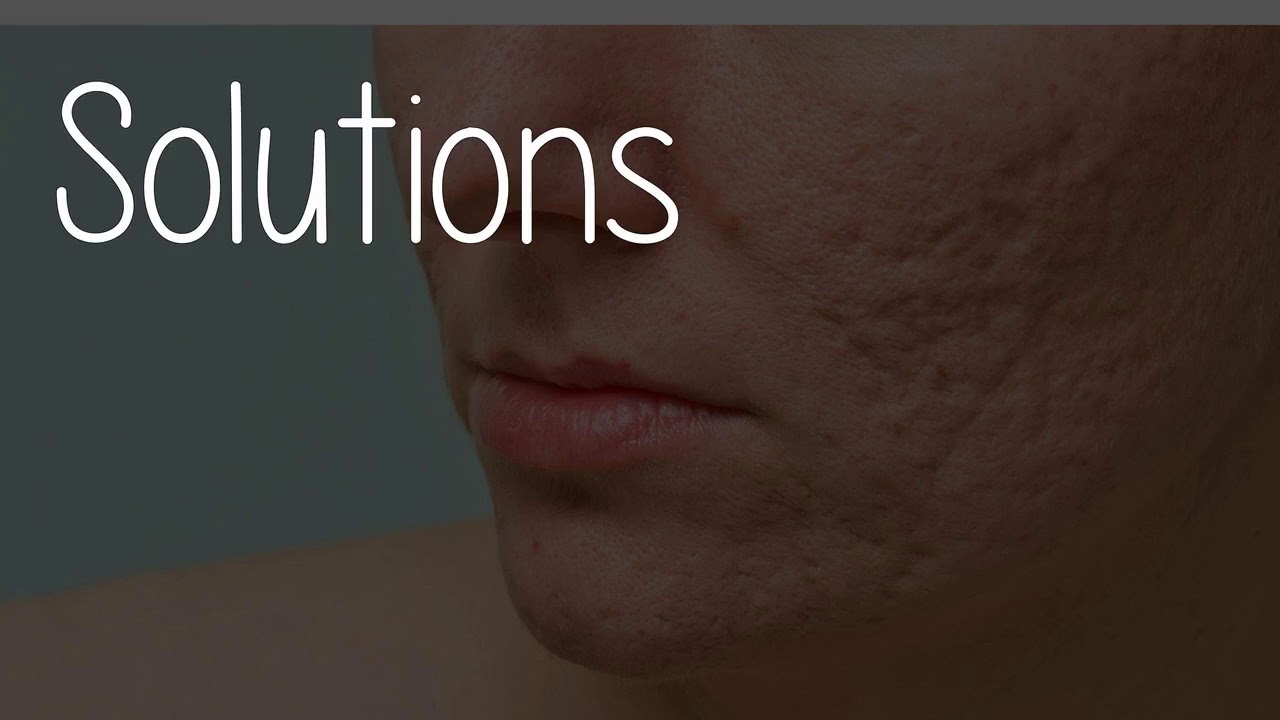 How Do I Get Rid Of Red Acne Marks All Over My Cheeks? - YouTube