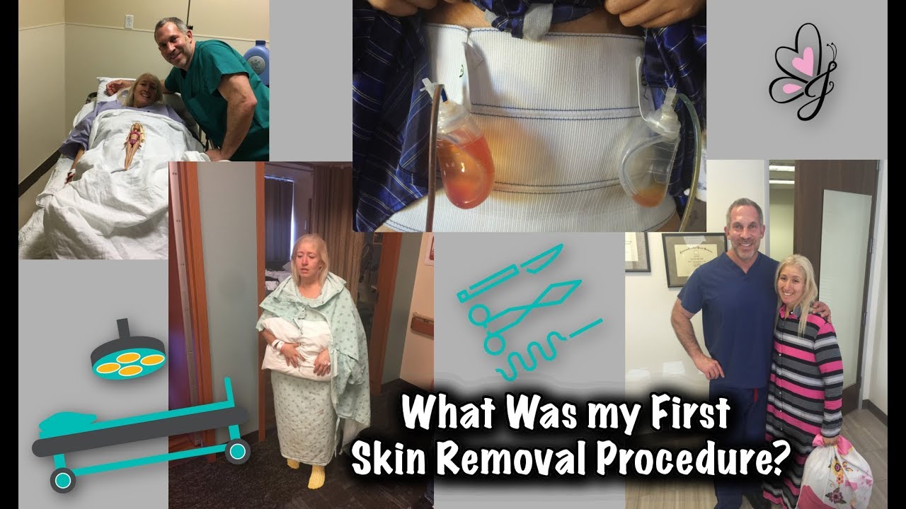 Skin Removal Procedure #1...Why Was This The Best Procedure For Me ...
