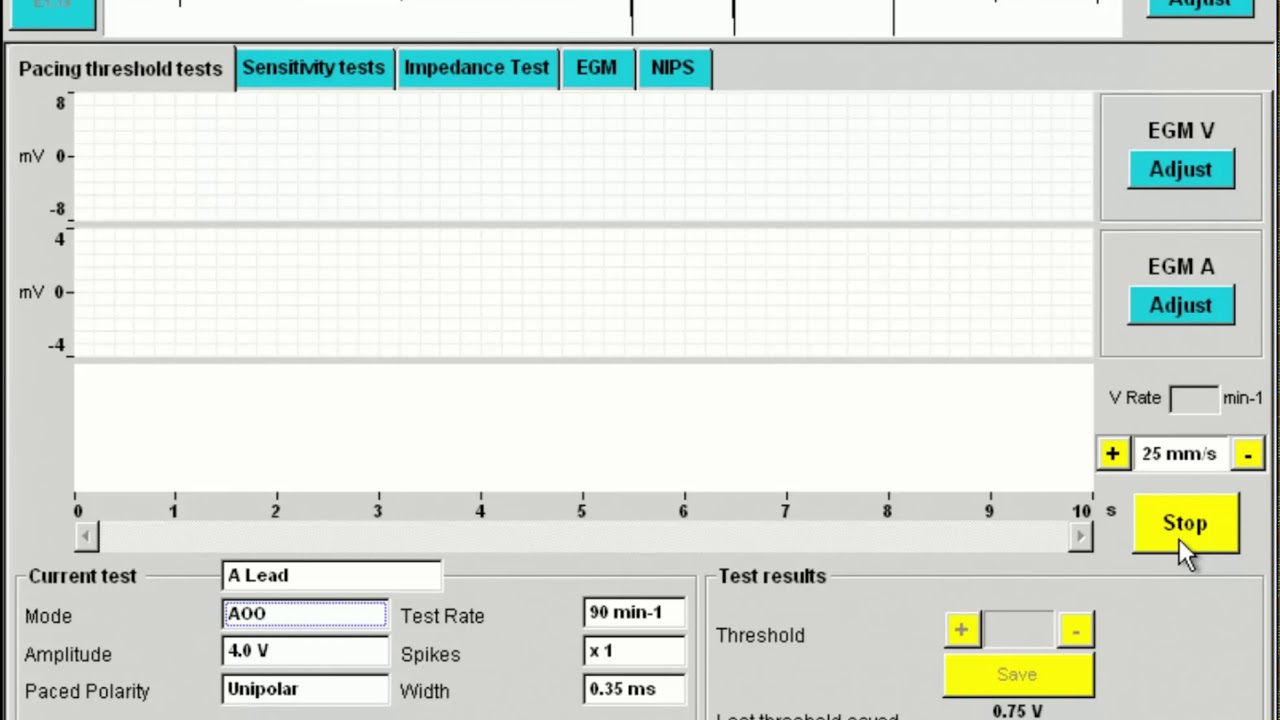 Interrogating a Microport pacemaker | Tests / EGM - YouTube