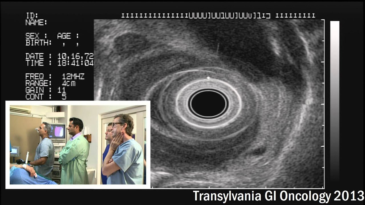 Stadializare si paleatie in cancerul esofagian Dr Mukul Arya & Dr ...